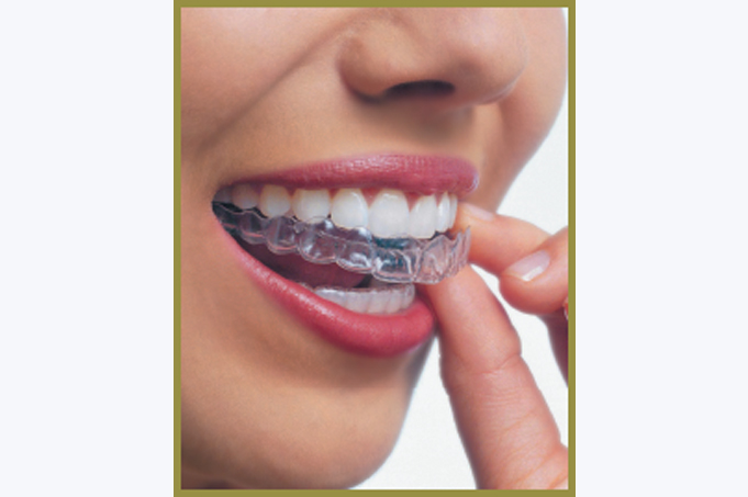 Five Tips for the Best Invisalign Experience | Norwest Orthodontics